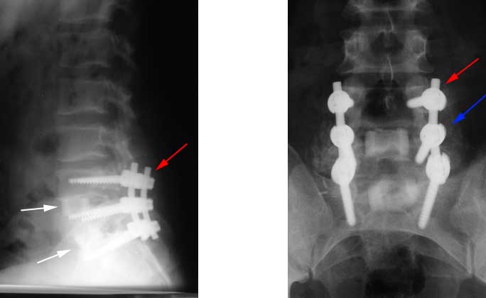 Lumbar Fusion - K Hannani MD Inc,