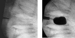 Kyphoplasty | K Hannani MD Inc,